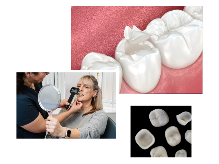 Dental Crowns - Toftwood Dental