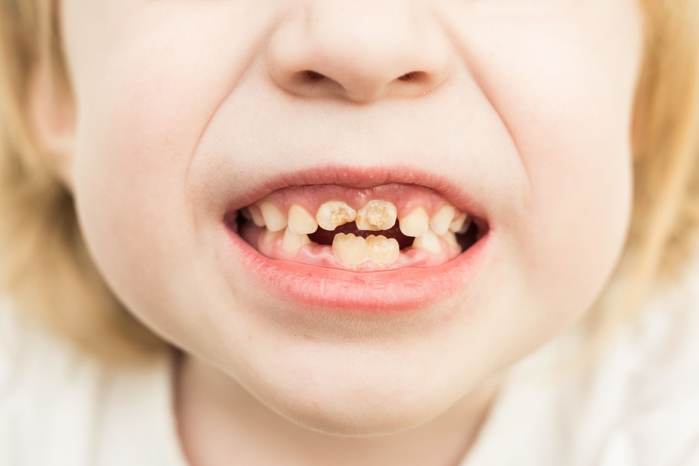 How to Prevent Children’s Rotten Teeth During Halloween? - Toftwood Dental